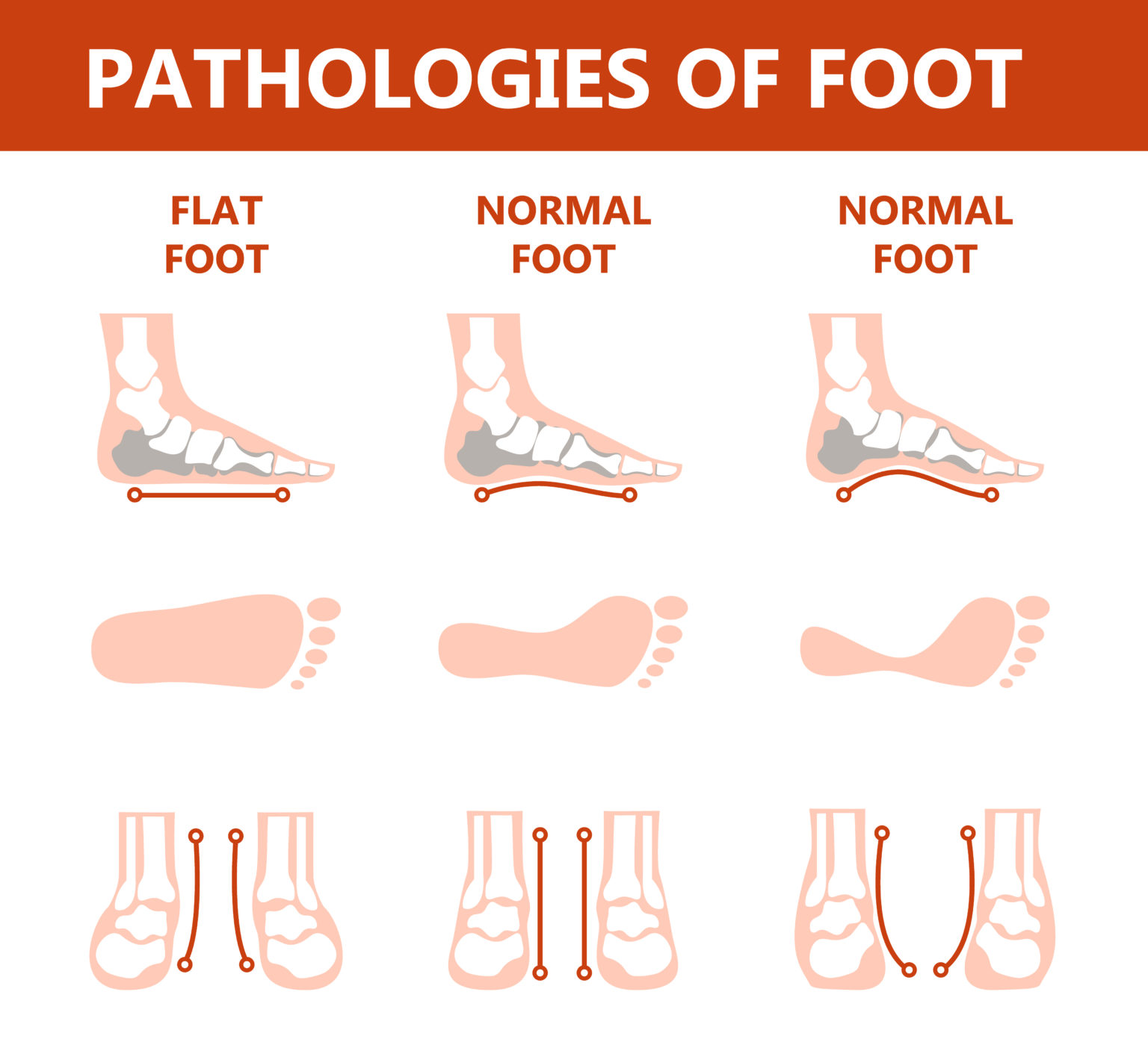 Foot pathologies infographic. Flat foot anatomy. Deformed - Bradford ...