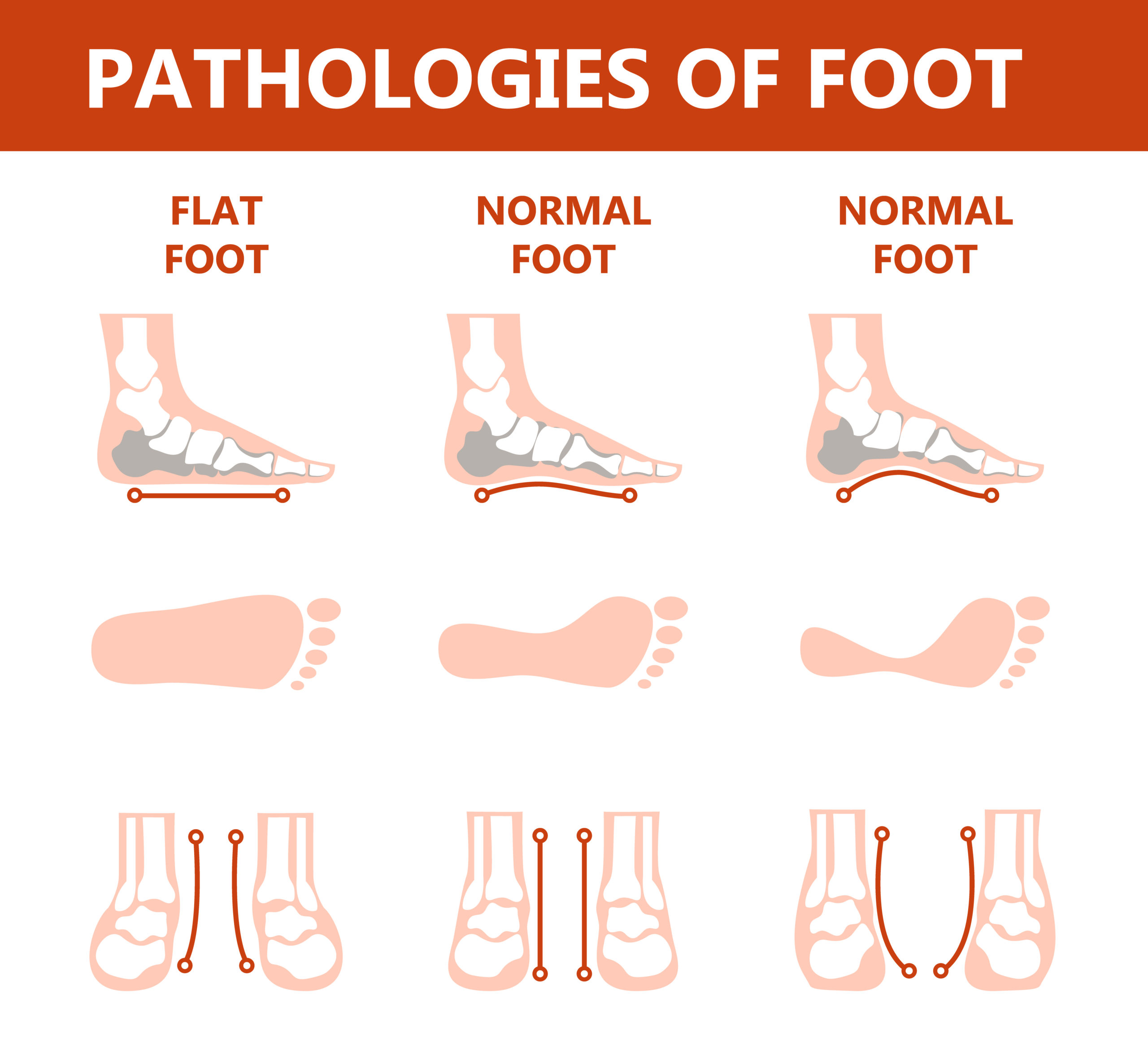 Foot pathologies infographic. Flat foot anatomy. Deformed - Bradford ...